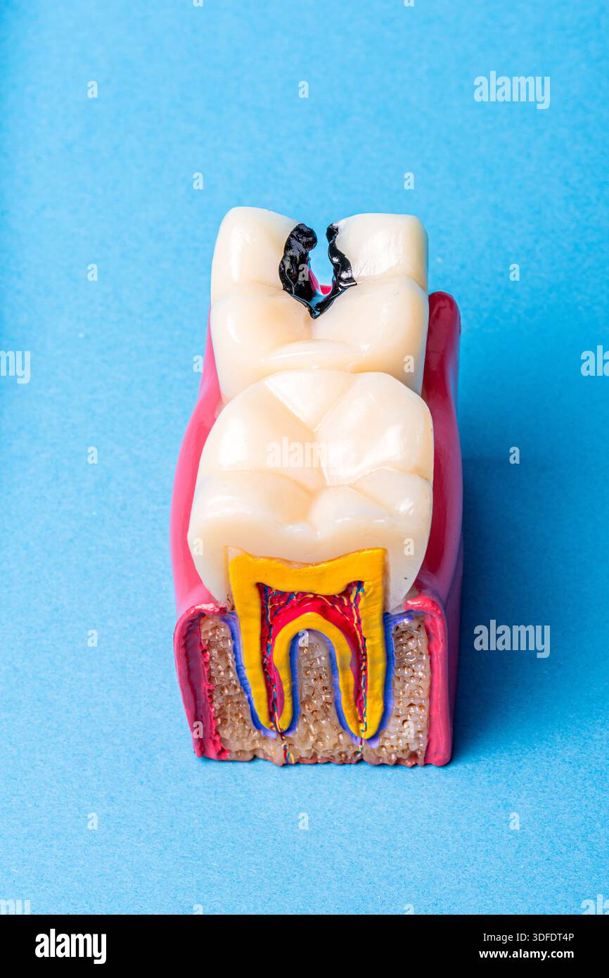 Dental molar cross section model showing enamel, dentin, pulp and an ...