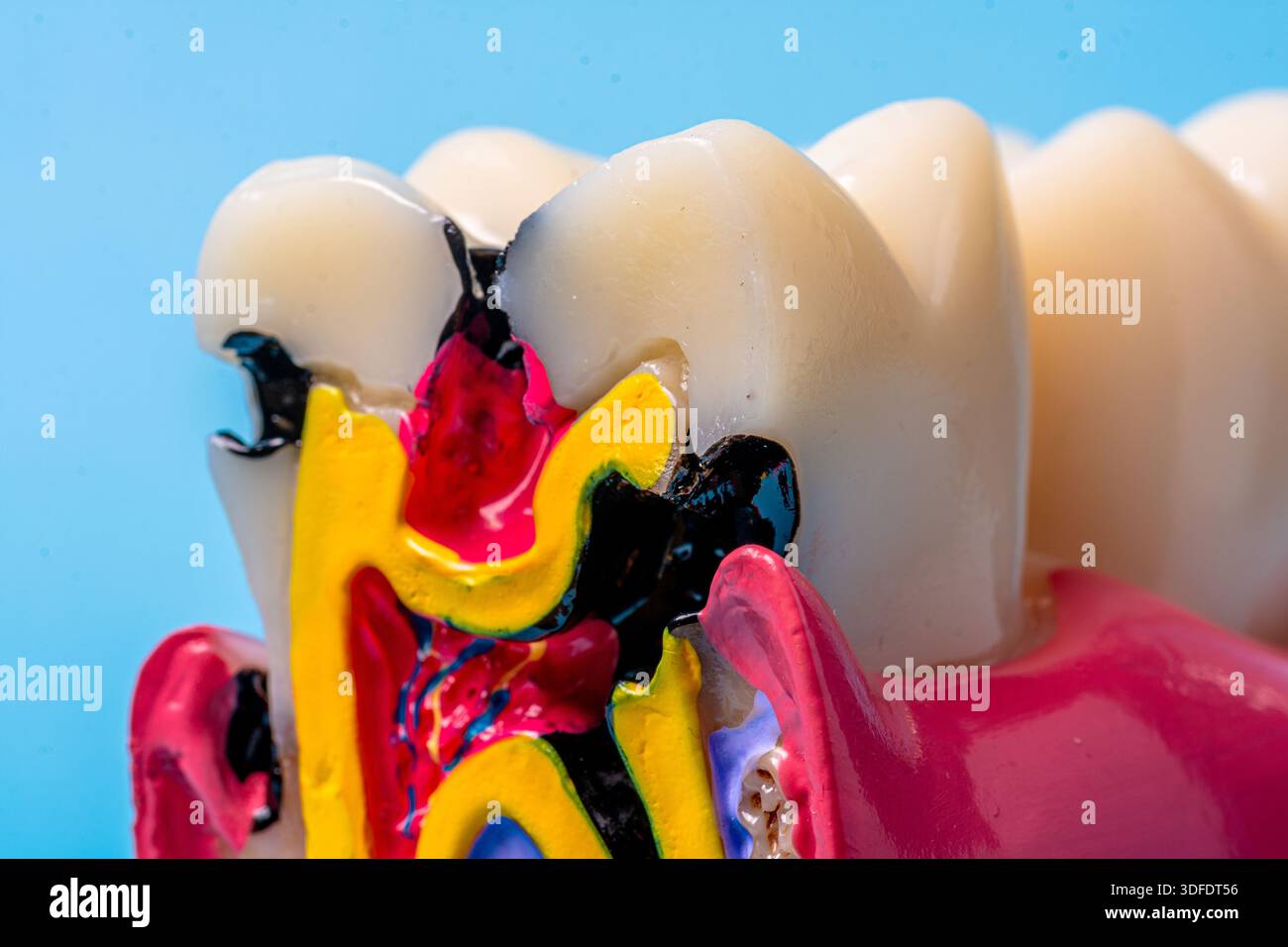 Dental anatomy model showing advanced tooth decay and caries Stock ...