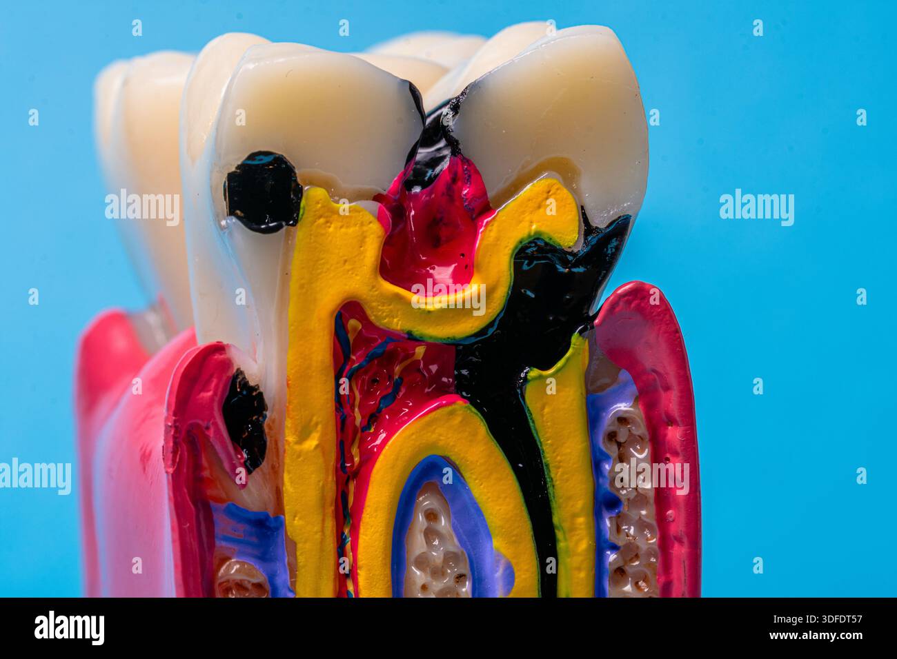 Dental model illustrating a molar and gum cross section, revealing the ...