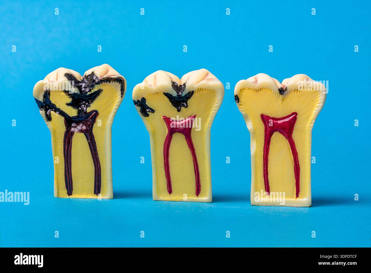 Dental models illustrating the progression of tooth decay, from early ...