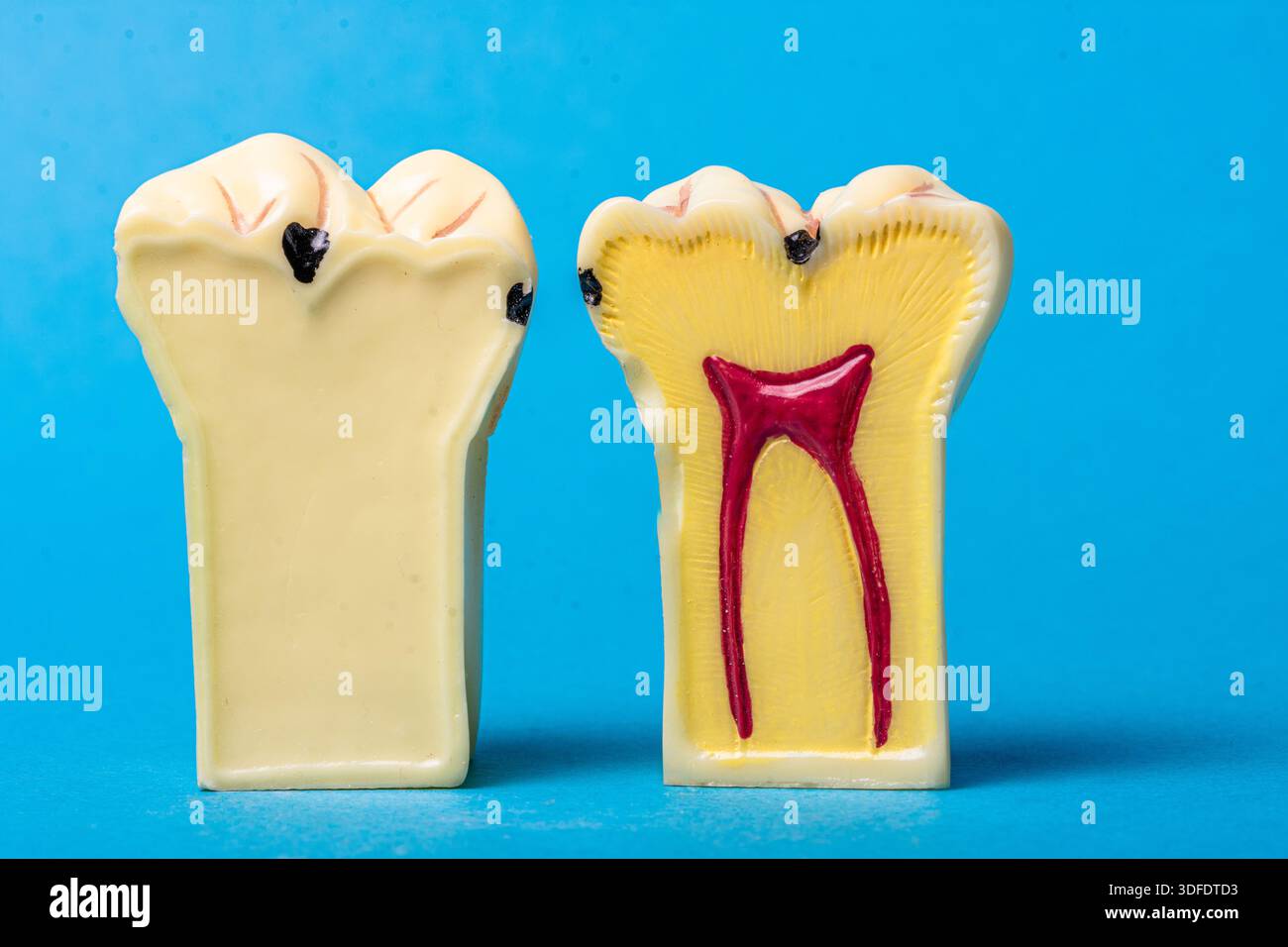 Dental model illustrating tooth decay on the exterior surface and a ...