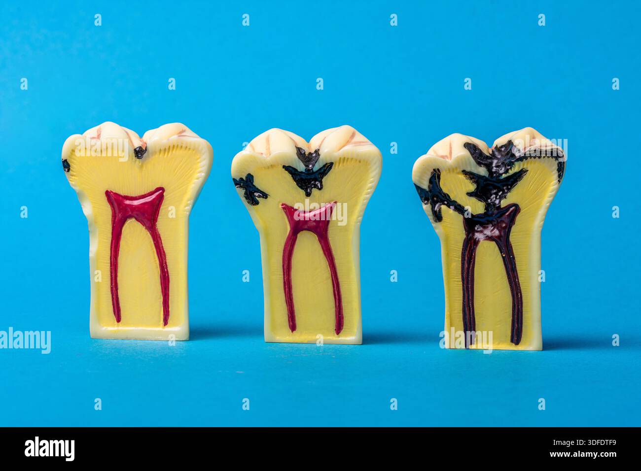 Dental models illustrate the progression from a healthy dentin ...