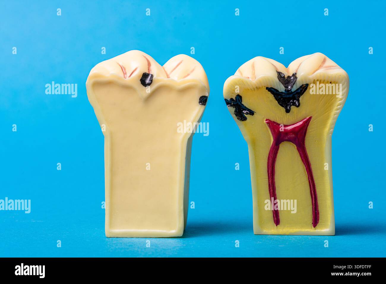 Dental tooth model illustrating the progression of tooth decay and ...