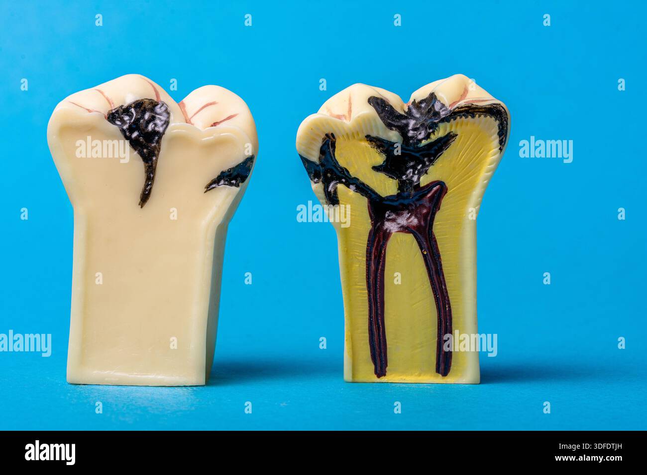 Dental model illustrating the progression of tooth decay, from an early ...