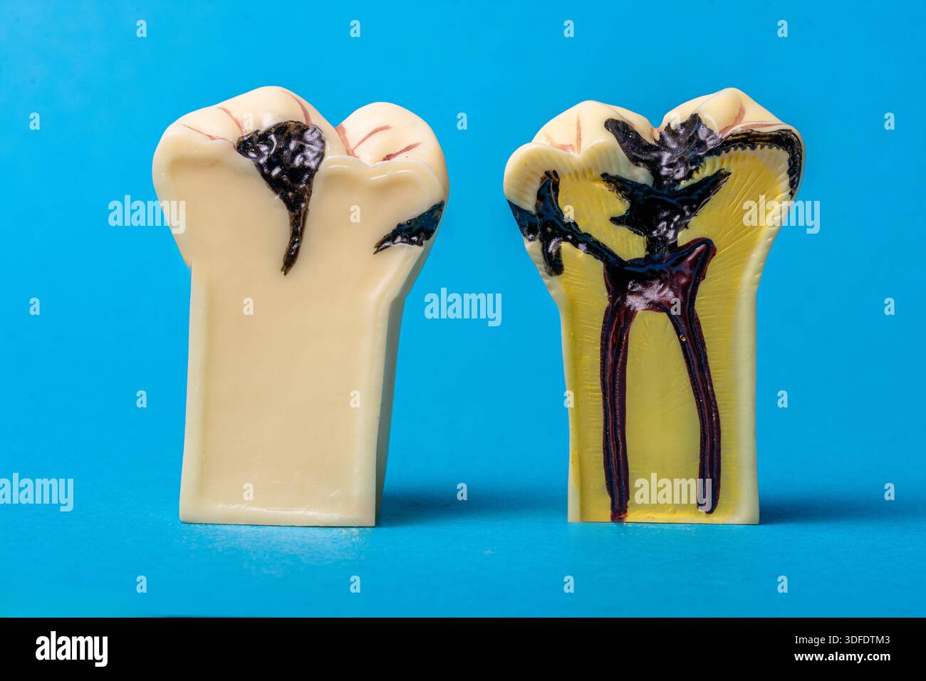 Tooth model showing advanced dental caries with cross section revealing ...
