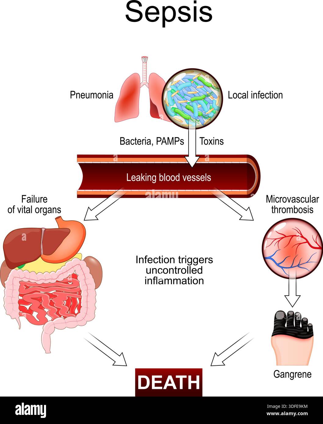 Sepsis skin hi-res stock photography and images - Alamy