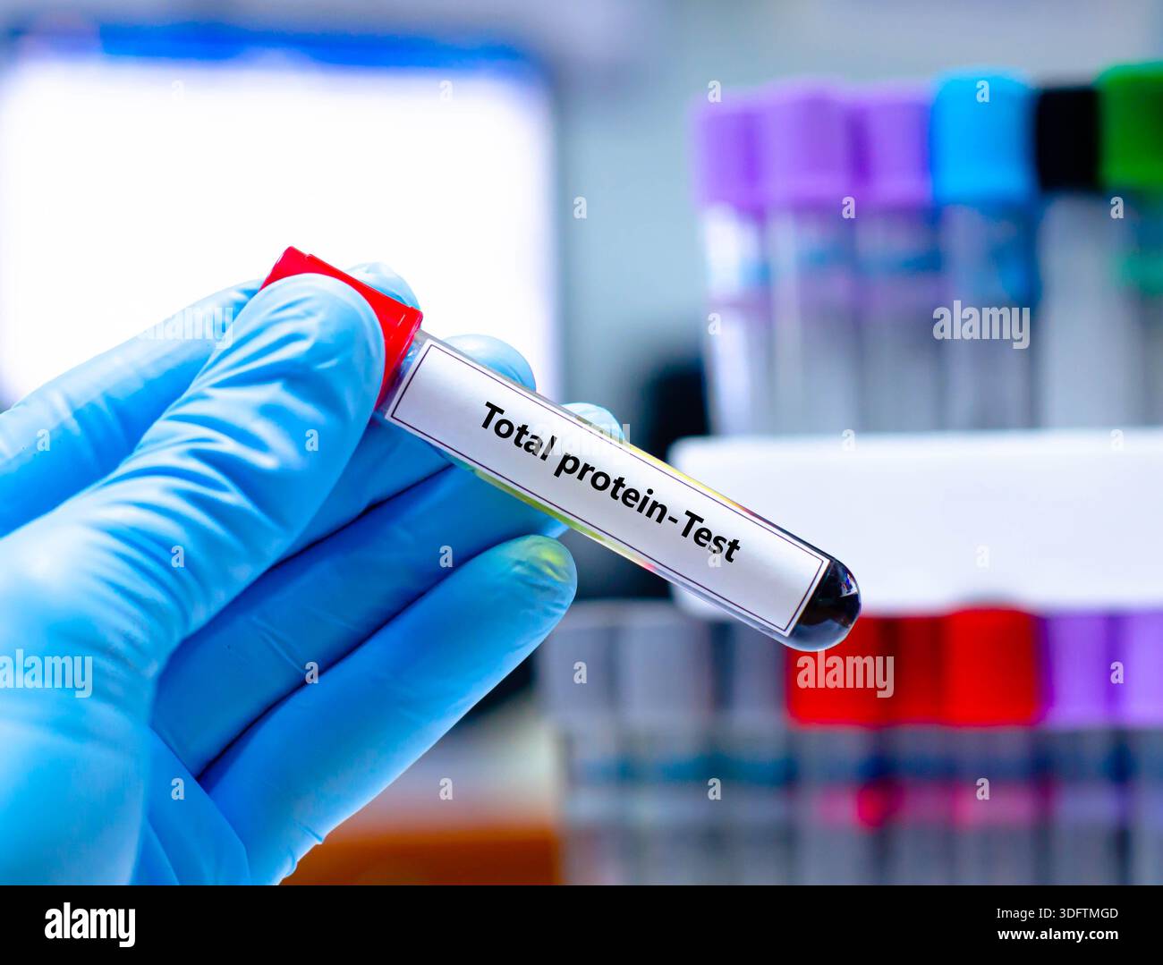 Total protein test hi-res stock photography and images - Alamy