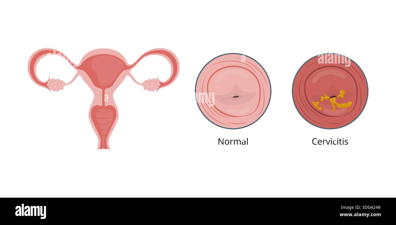 Human cervix hi-res stock photography and images - Alamy