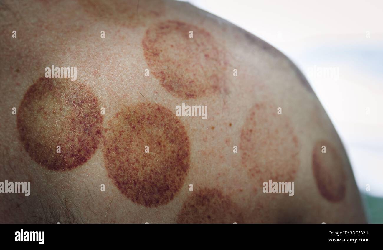 Circular bruises on a back and shoulder after cupping therapy Stock ...
