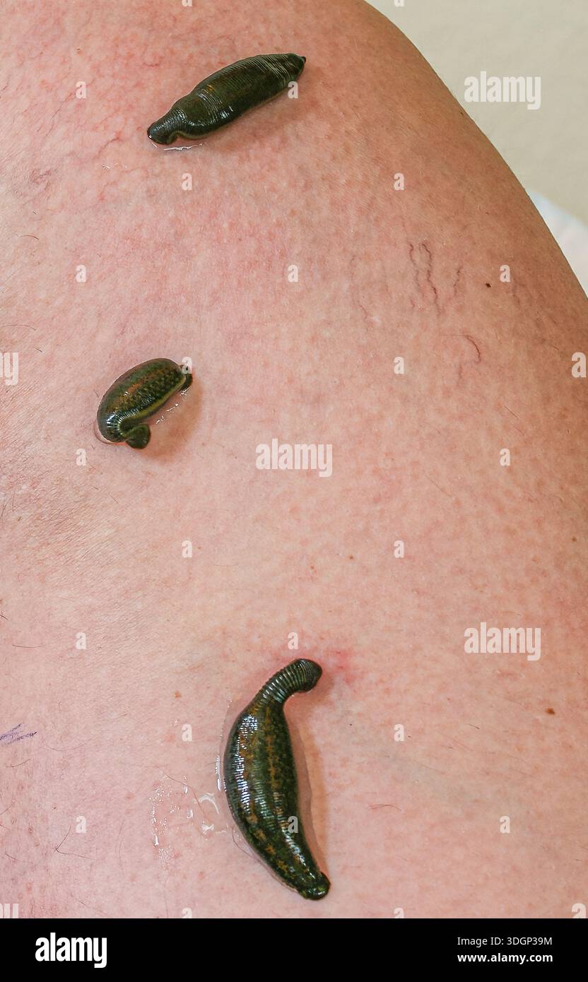 Leeches medicine hi-res stock photography and images - Alamy