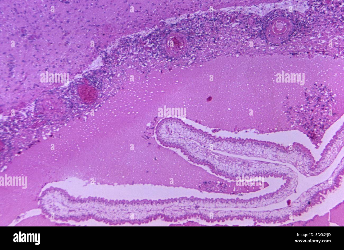 Photomicrograph at 50X shows histopathologic features in a brain tissue ...