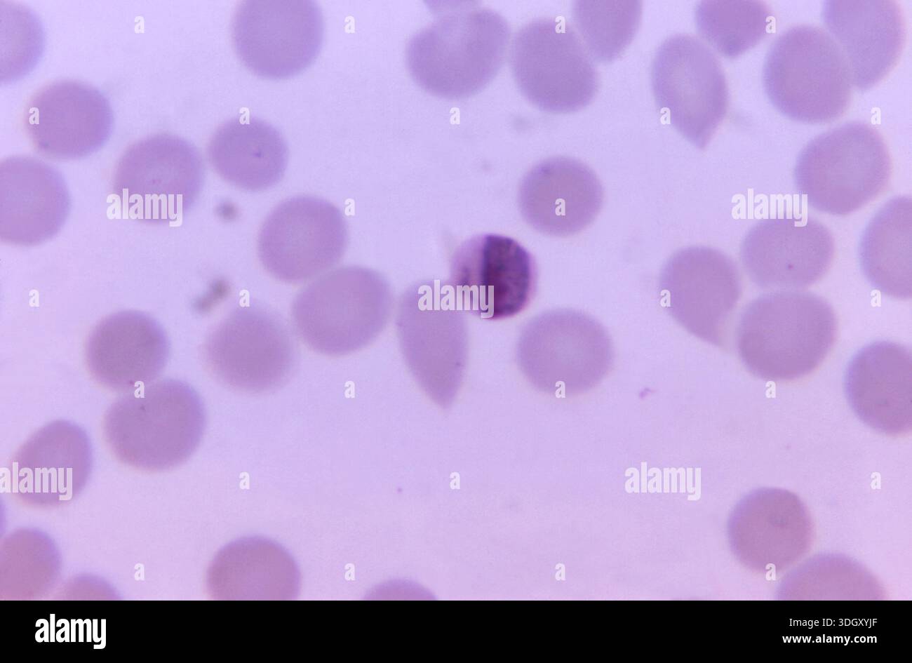 Photomicrograph of a Giemsa-stained thin film blood smear showing a ...