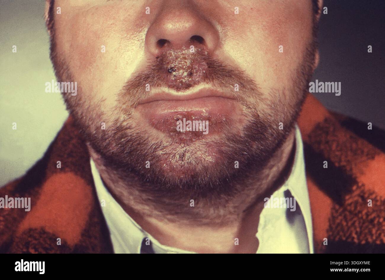Anterior view of a man's face showing scaly cutaneous lesions and ...