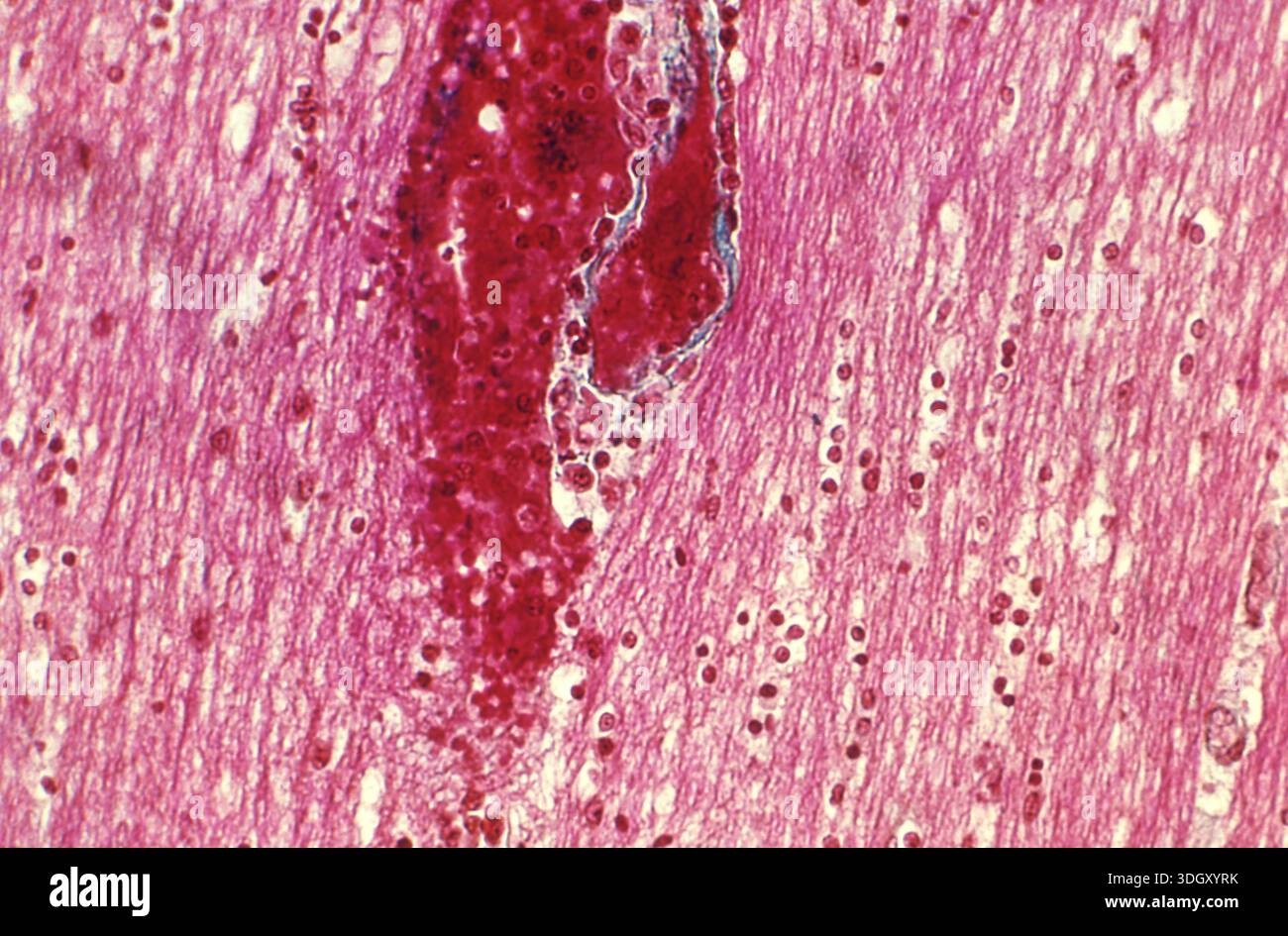 A photomicrograph shows a section of brain tissue with hemorrhage from ...