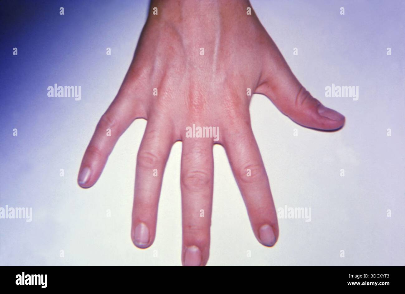 Dorsal view of a patient's right hand showing swelling of the finger ...