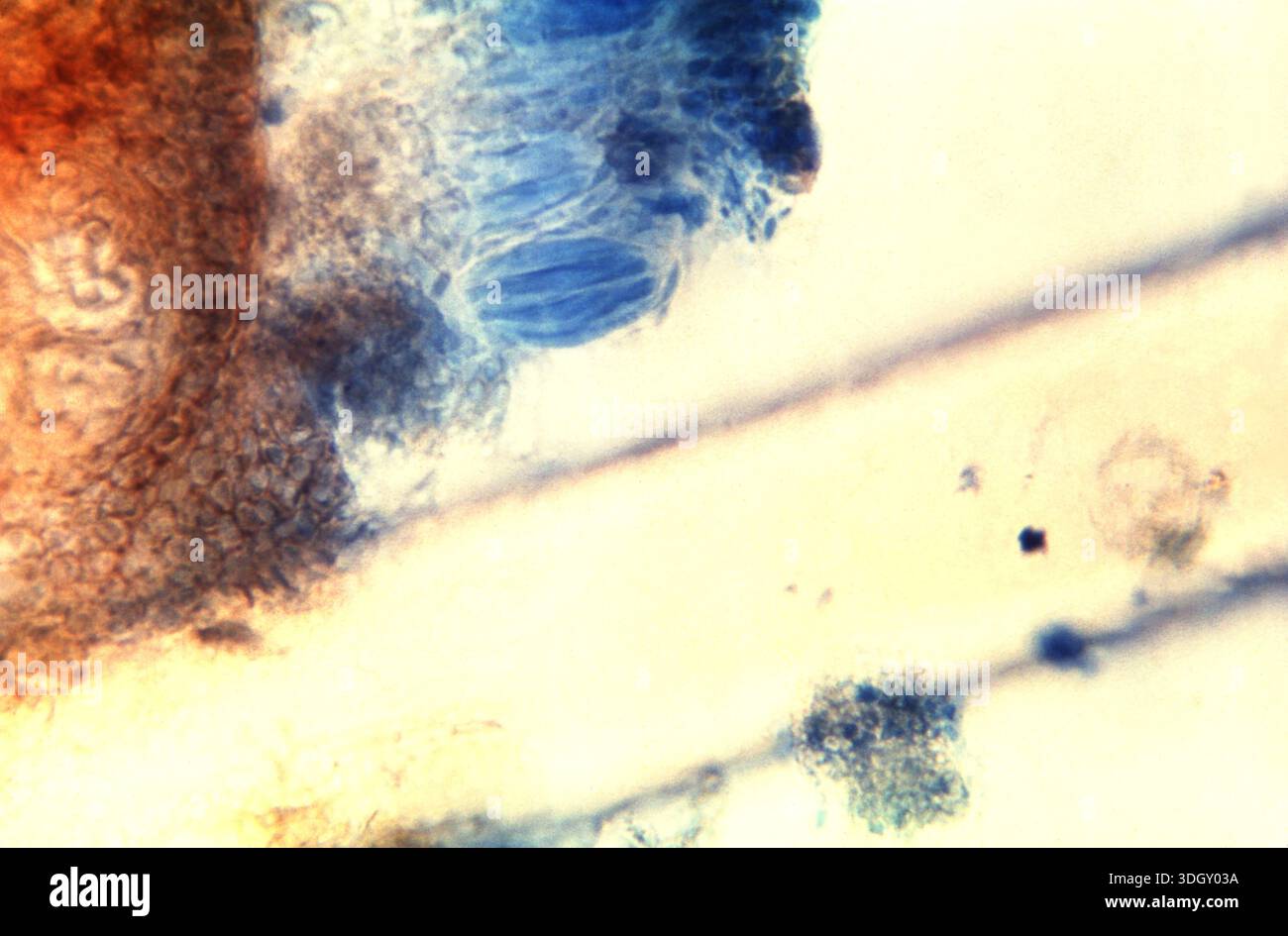 Photomicrograph of a human hair shaft from a patient with black piedra ...