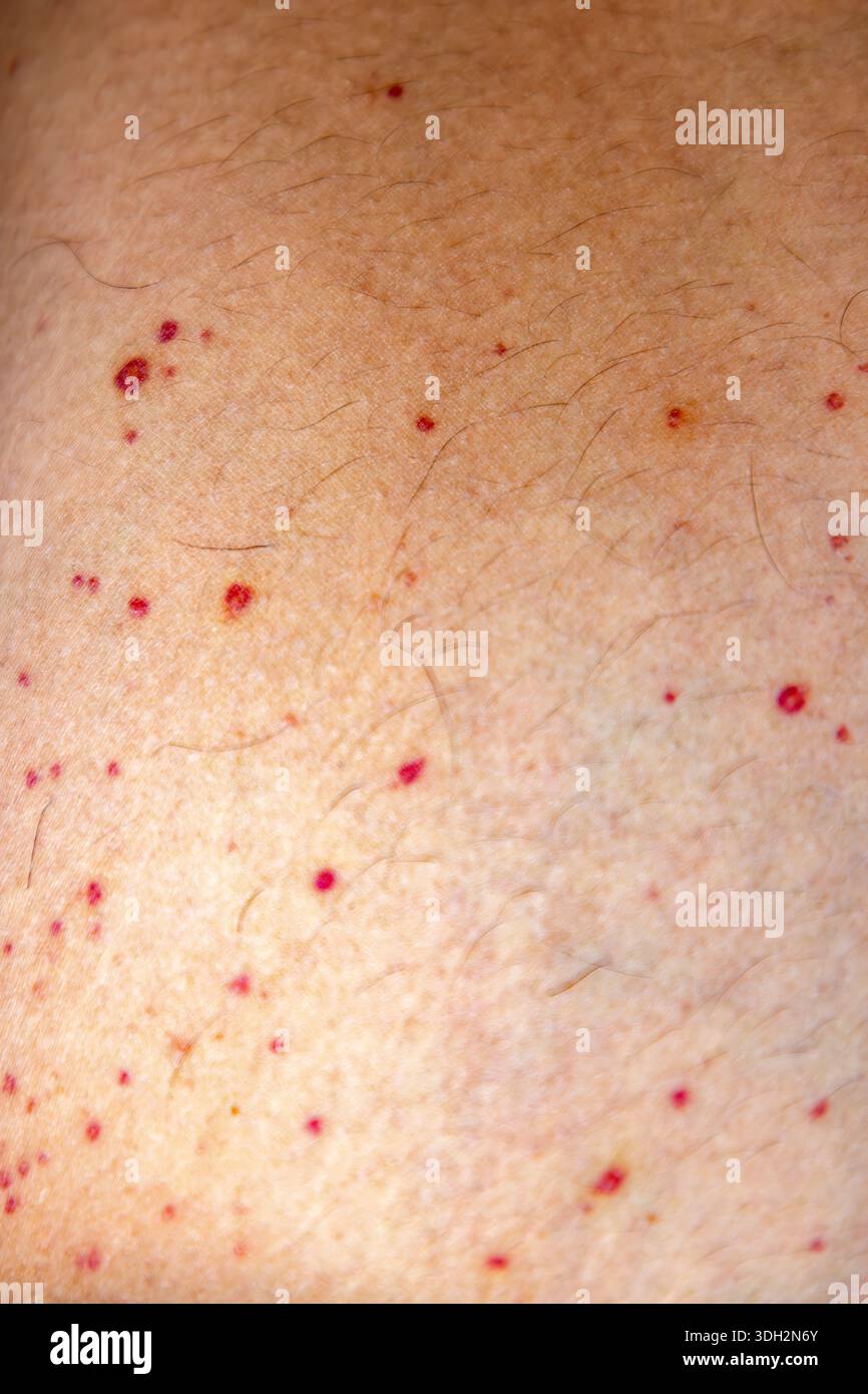 Signs of vasculitis visible on arms and legs, showing red spots and ...