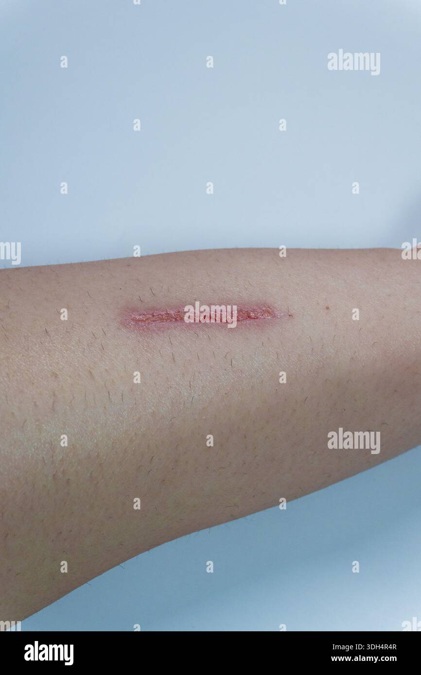 Laceration wound hi-res stock photography and images - Alamy