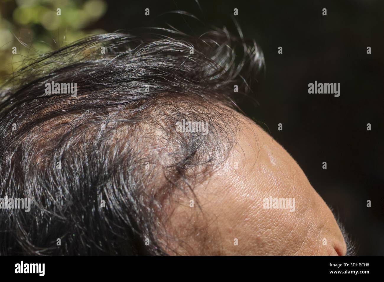 Male forehead with thinning black hair and scalp problem showing age ...