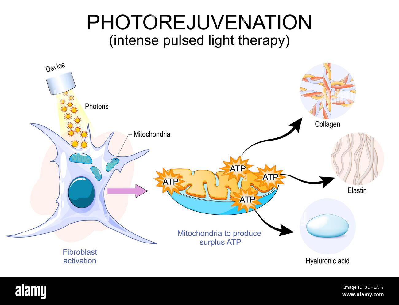 Skin photorejuvenation. Process of Photofacial treatment. Intense ...