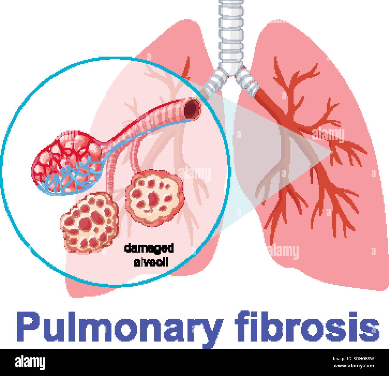 Vector illustration of lungs with detailed view of alveoli damage ...