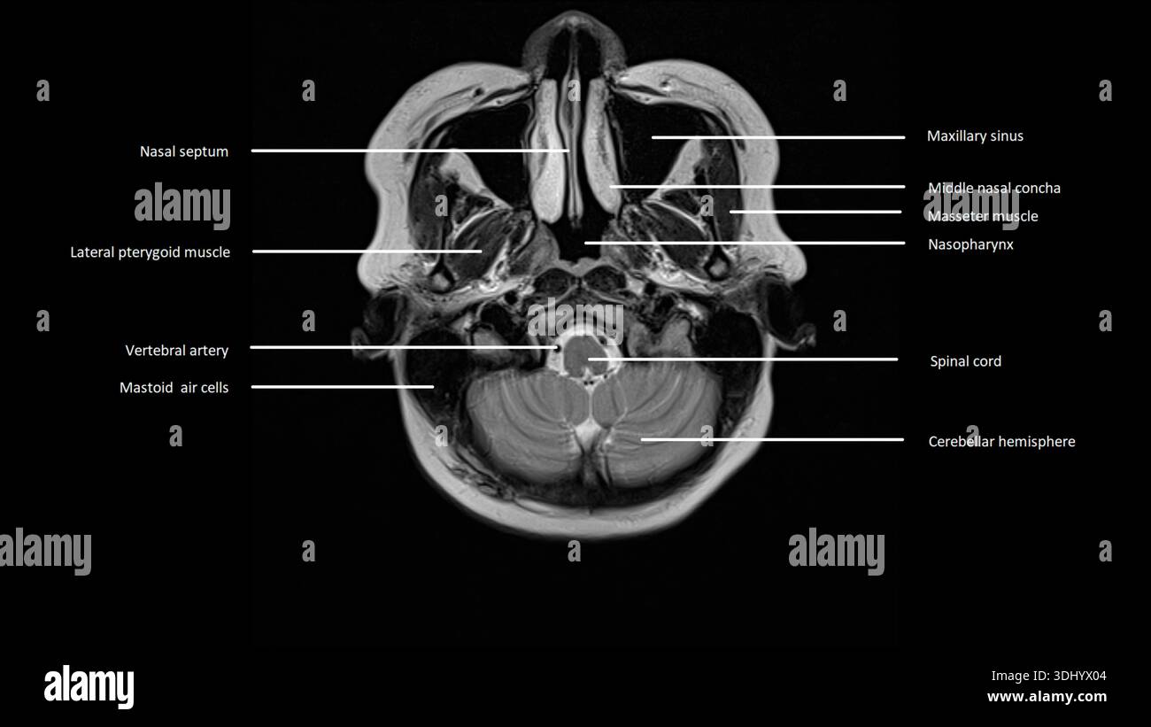 Labelled magnetic resonance imaging (MRI) scan of an axial section of a ...