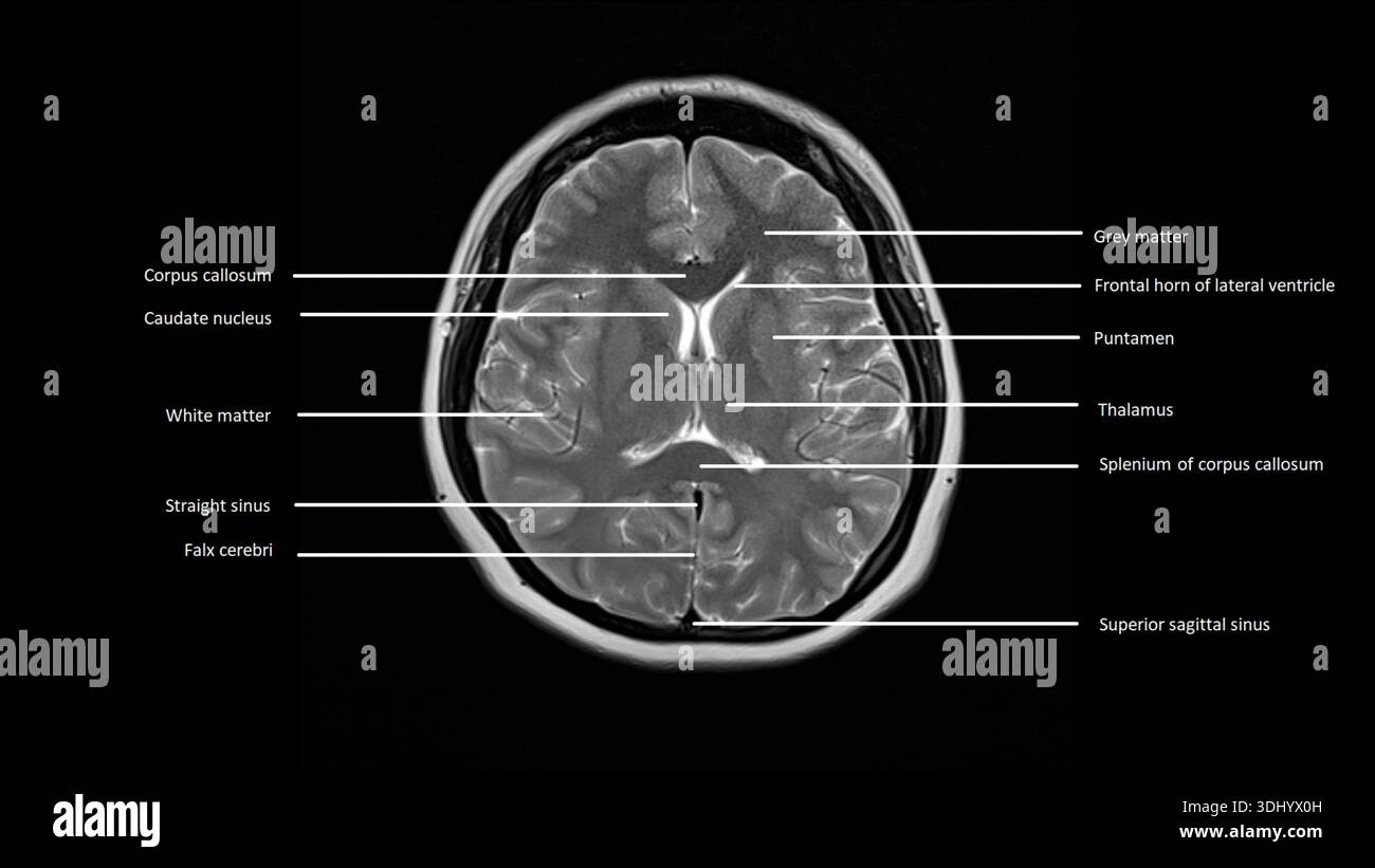 Labelled magnetic resonance imaging (MRI) scan of an axial section of a ...