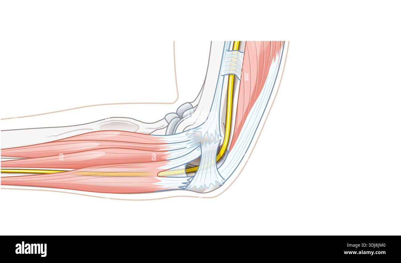 Detailed elbow anatomy illustration showing ulnar nerve entrapment ...
