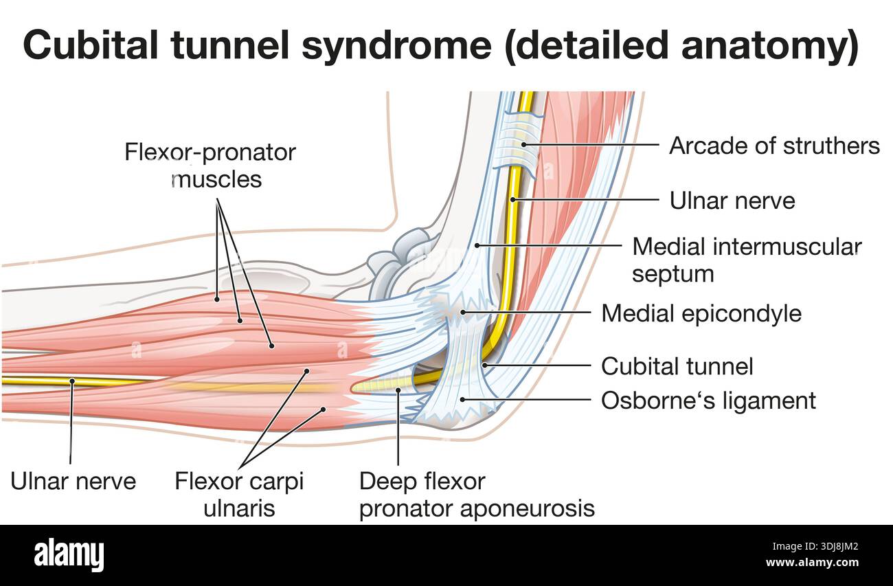 Detailed elbow anatomy illustration showing ulnar nerve entrapment ...