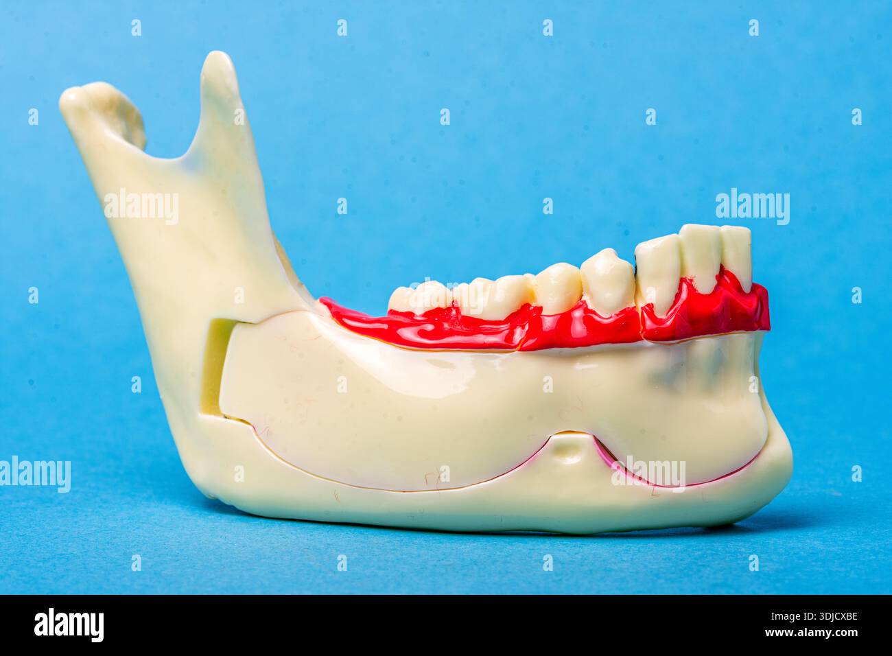 Dental jaw model illustrating common oral health issues like gum ...