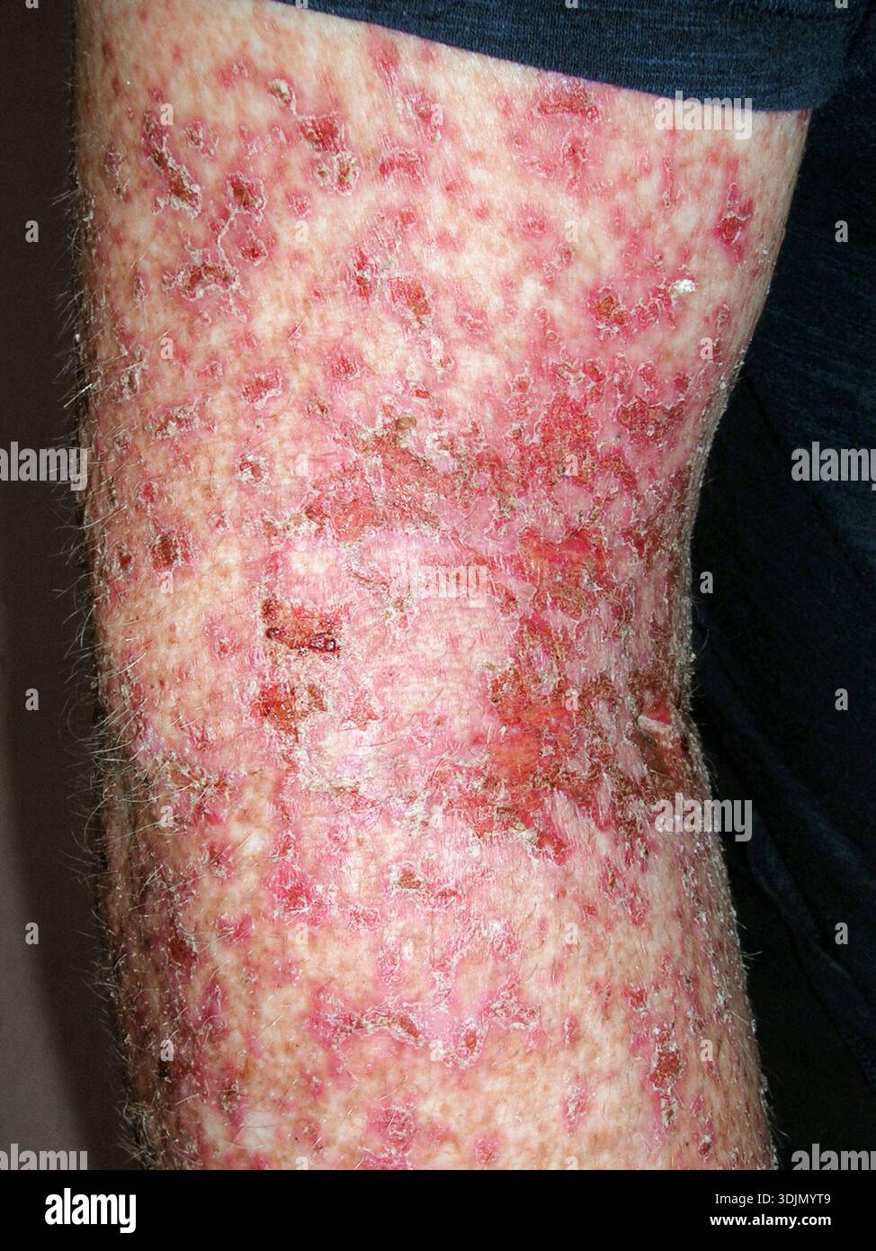 Arm of a 67 year old white man showing a severe skin reaction after ...