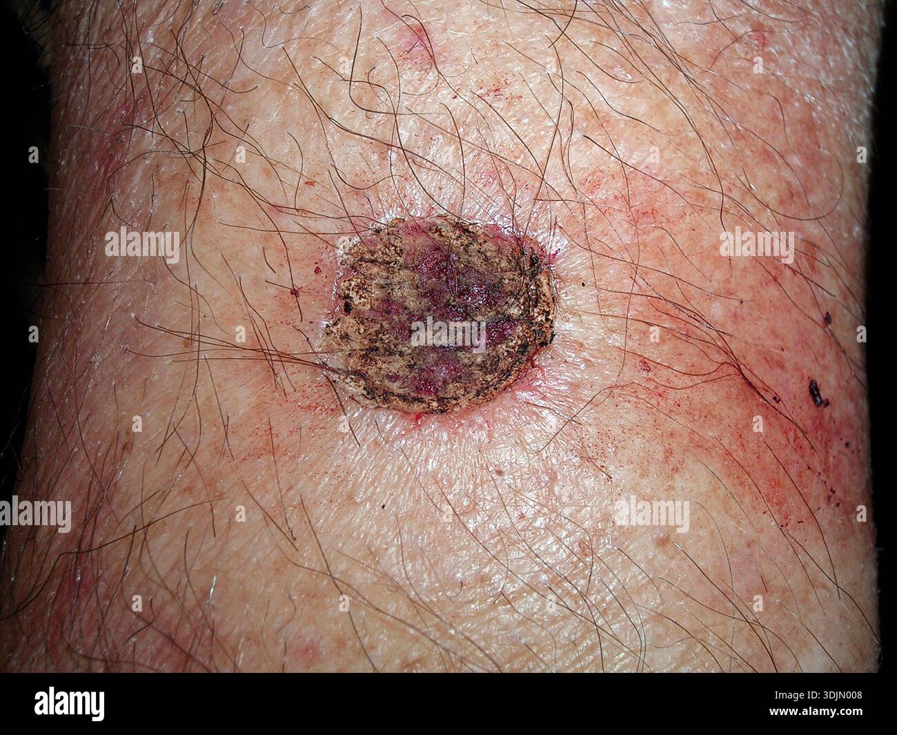 Electrodesiccation and curettage of Bowen's disease on the arm of a 51 ...