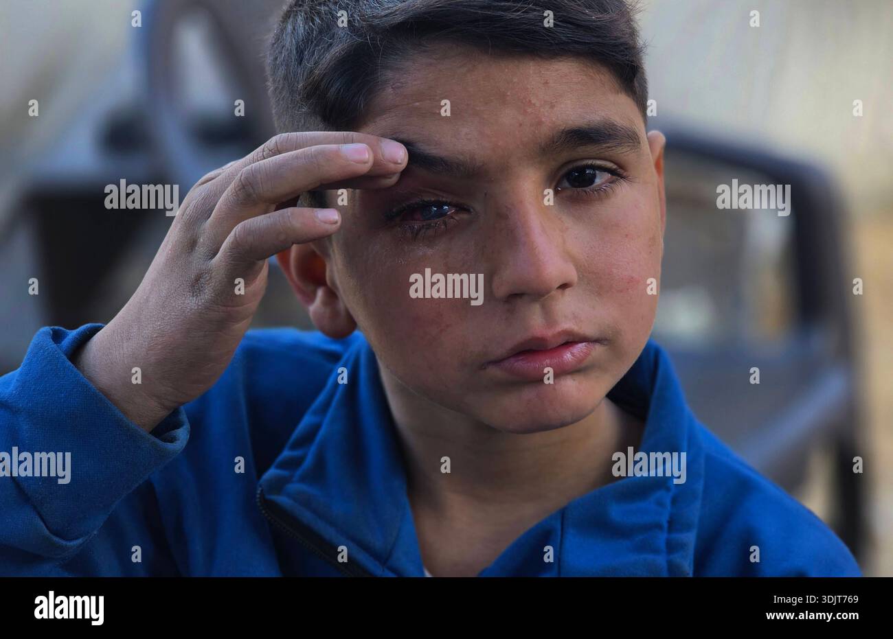 Nine-year-old Abdul Rahman al-Sharafi is at risk of losing his sight ...