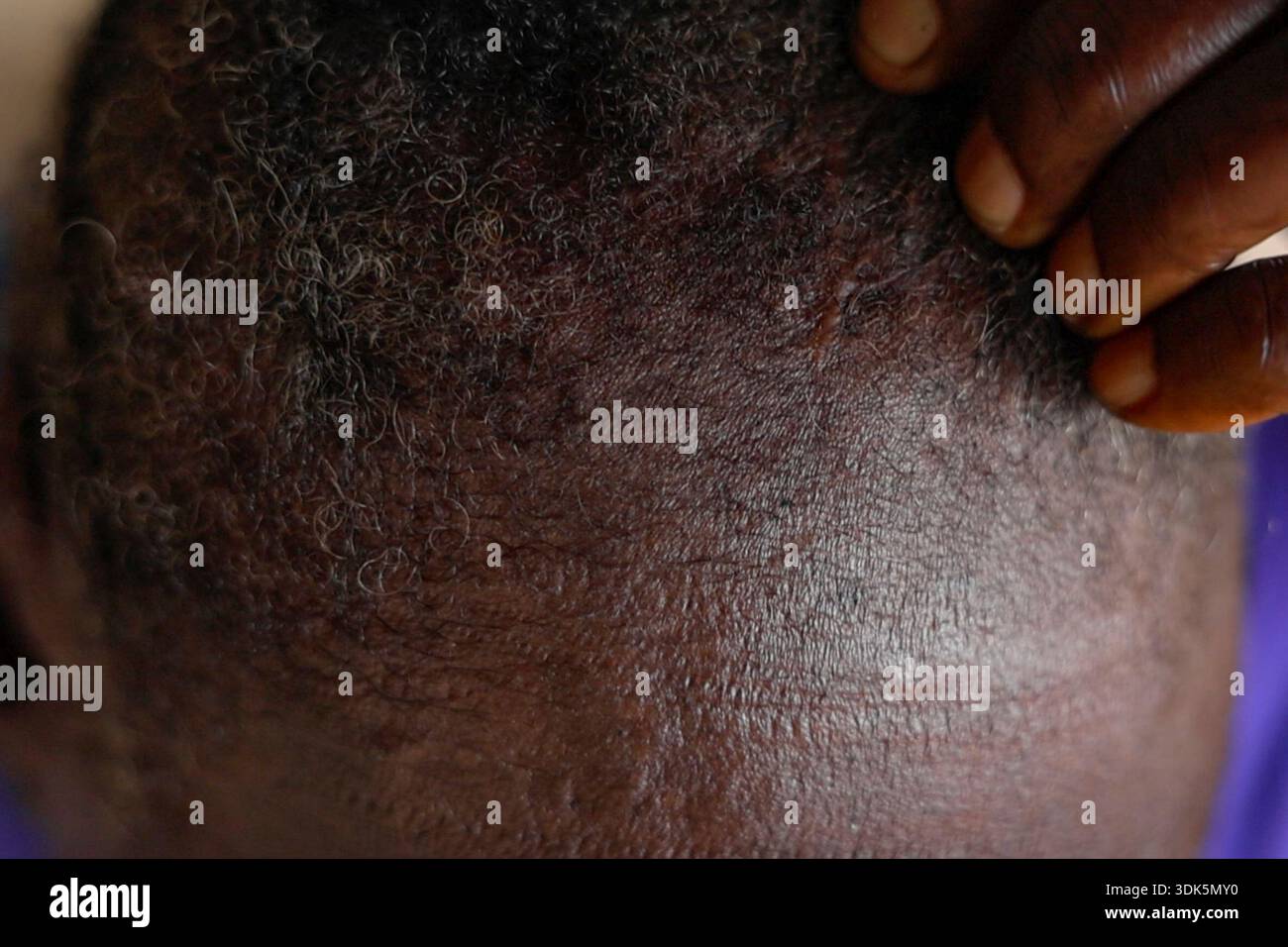 Satta Surtual shows a scar from an injury sustained during a protest in ...