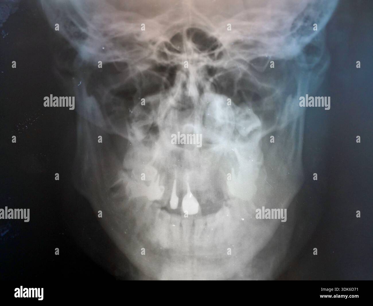 Frontal view of a human head X-ray showing skull structure, jaw, and ...