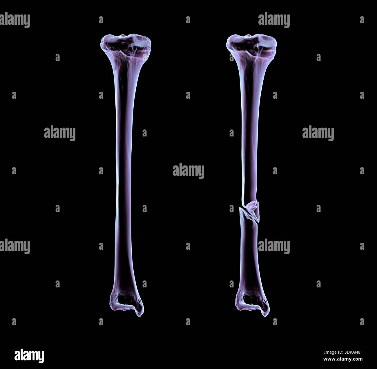 Illustration of a normal tibia bone (right) and tibia with shaft ...