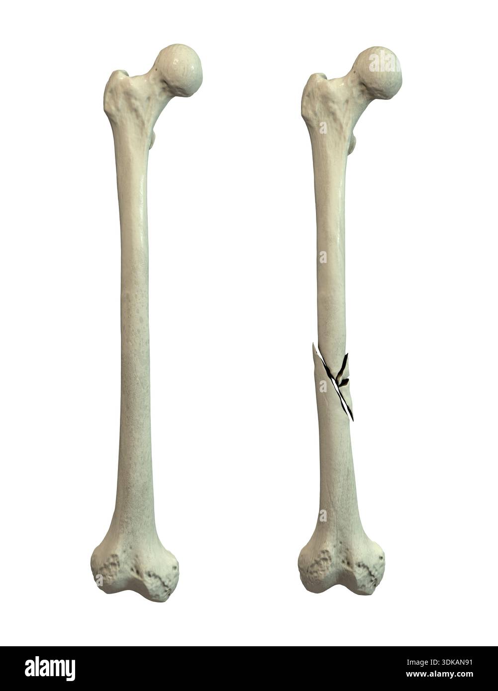 Illustration of a healthy femur bone (left) and a femur bone with shaft ...