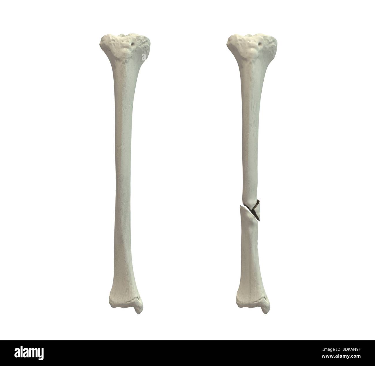 Illustration of a normal tibia bone (right) and tibia with shaft ...