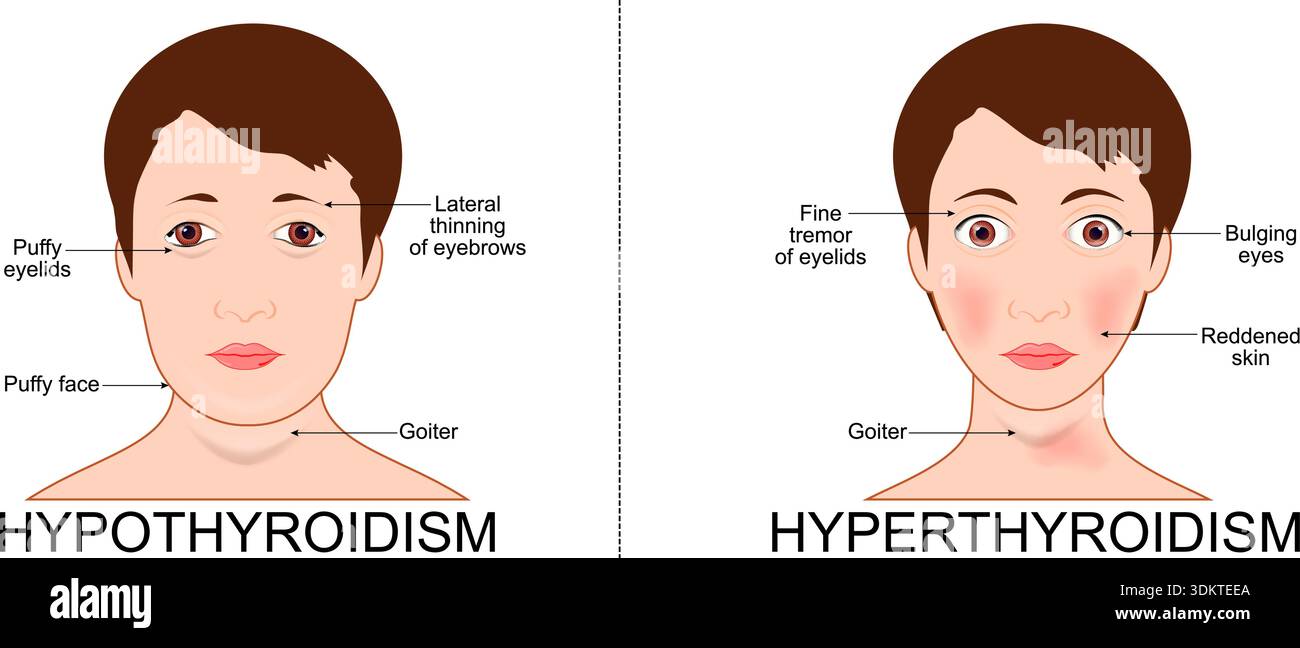 Hyperthyroidism and Hypothyroidism. Signs and symptoms of endocrine ...