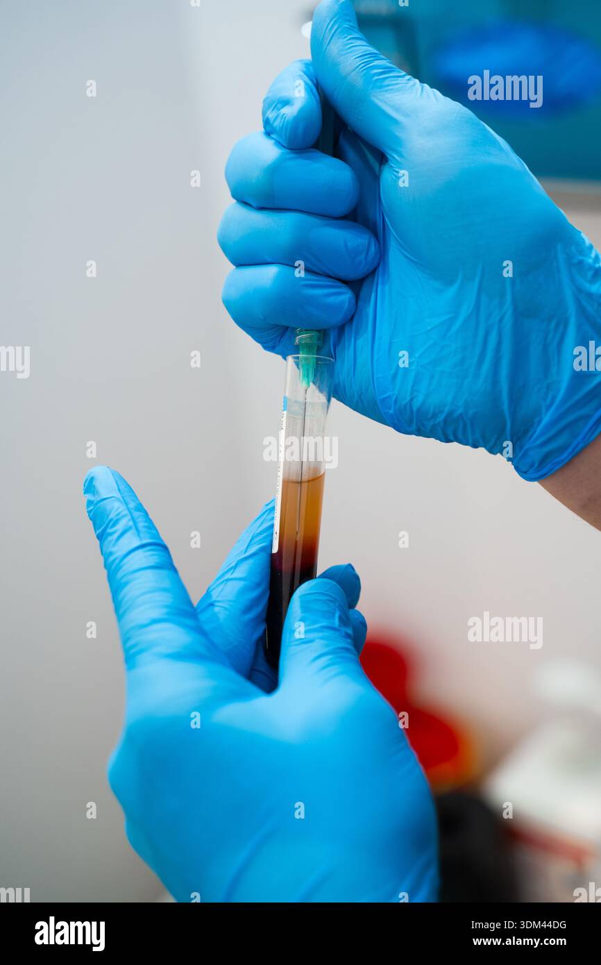 Centrifuged blood sample showing separated plasma prepared for PRP ...