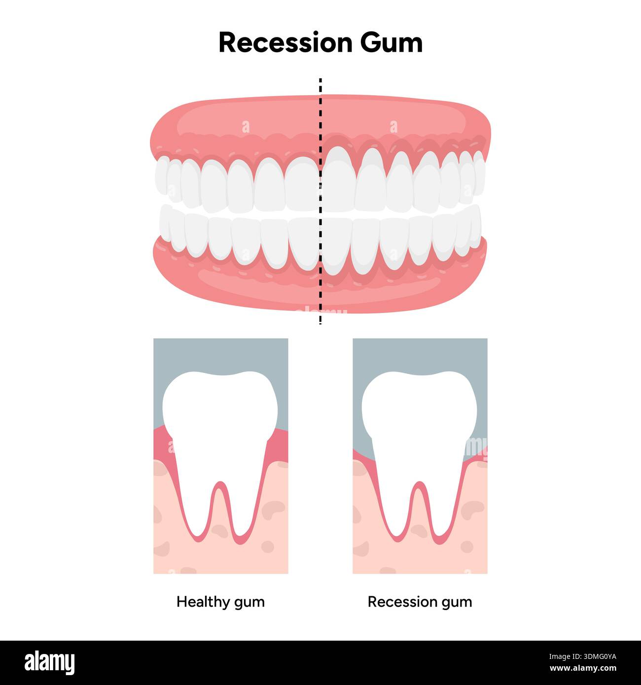 Hand-drawn dental illustration of gum recession treatment. Educational ...