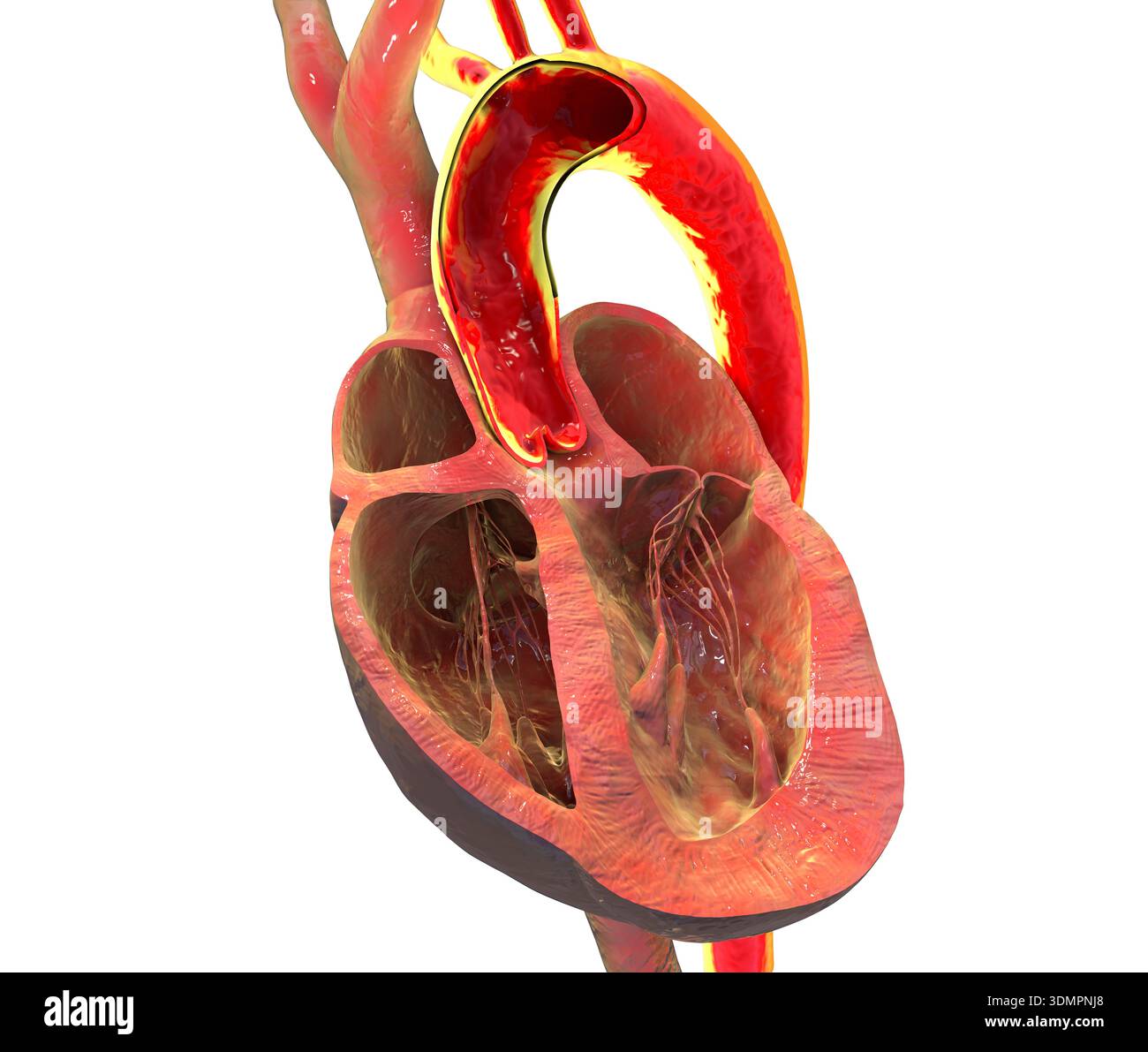 Illustration of the aorta and heart anatomy, showing a normal ascending ...