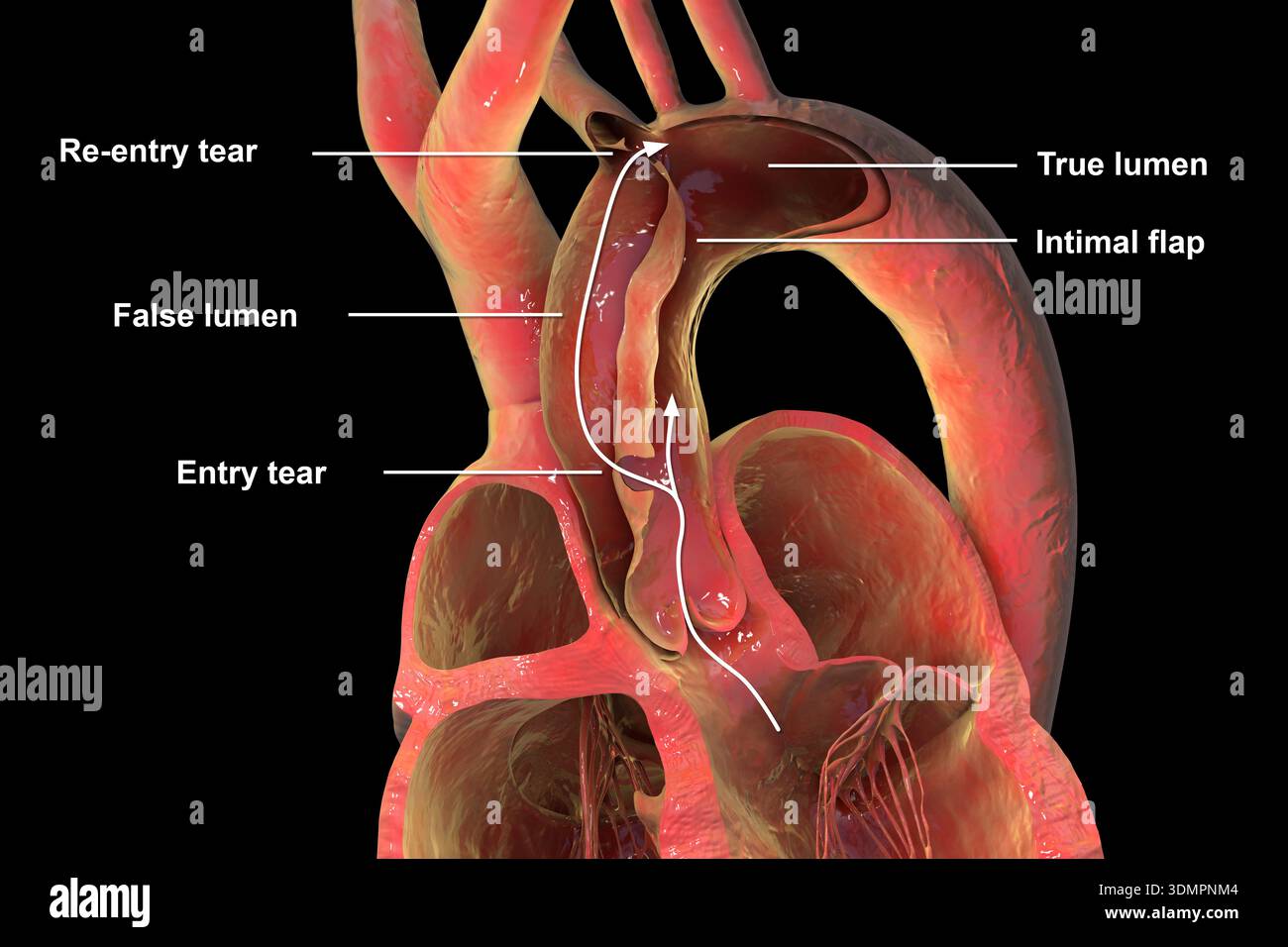 Illustration of an ascending aortic dissection, highlighting an intimal ...