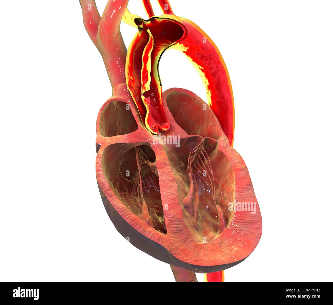 Illustration of an ascending aortic dissection, highlighting an intimal ...