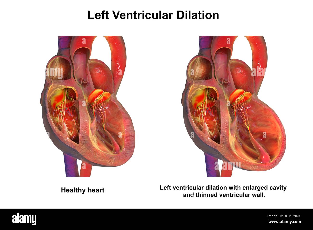 Illustration of a healthy heart (left) compared to a heart with left ...