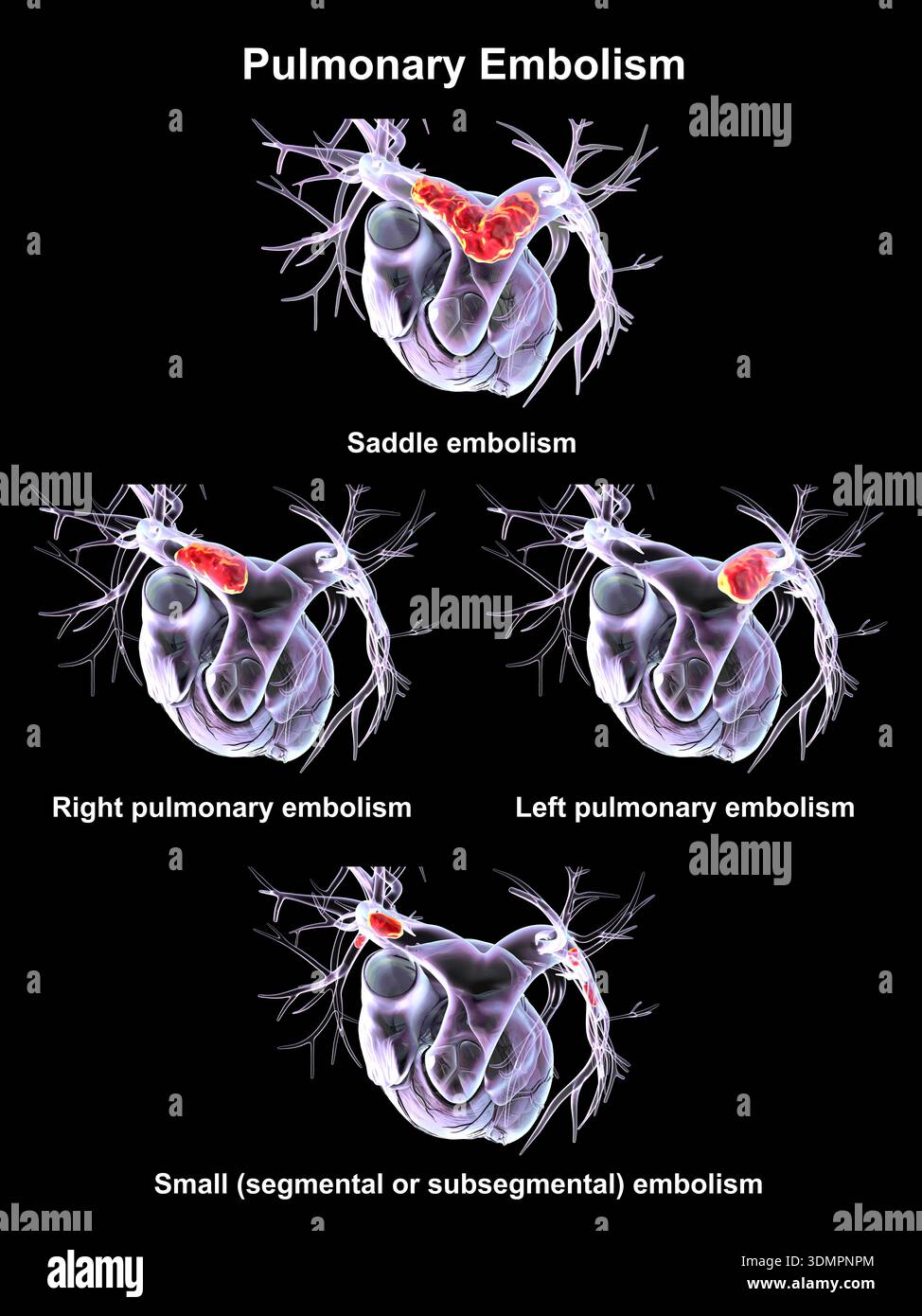 Illustration of types of pulmonary embolism, showing saddle, right ...