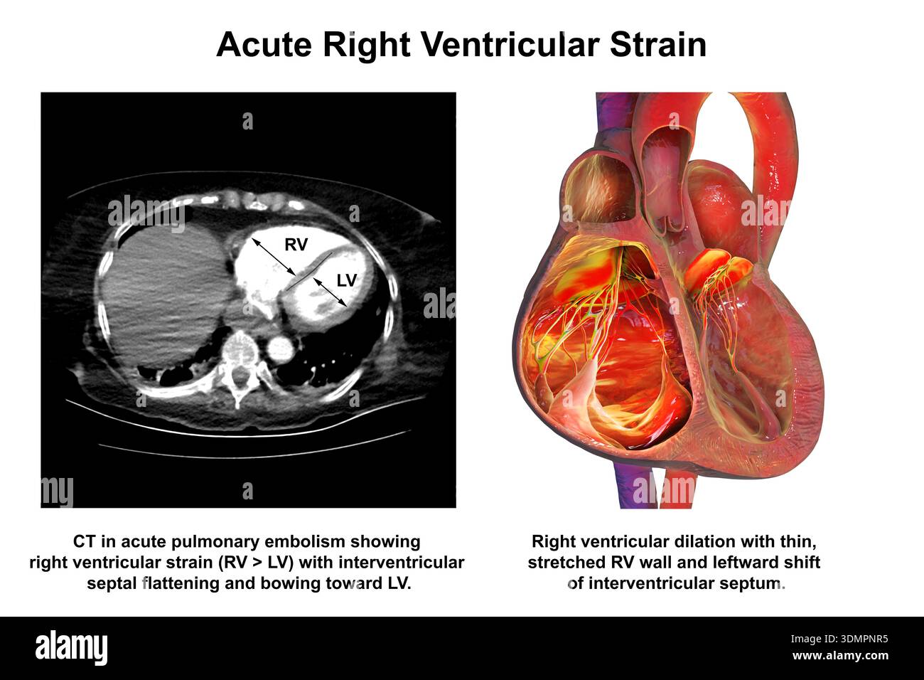 Ventricular septum hi-res stock photography and images - Alamy