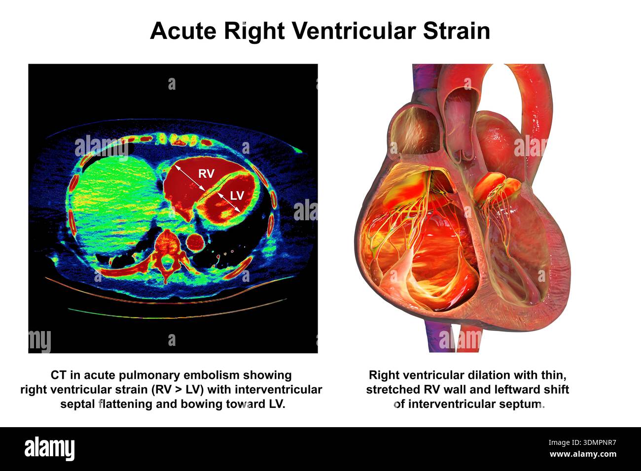 Illustration of right ventricular dilation showing a CT scan (left) and ...