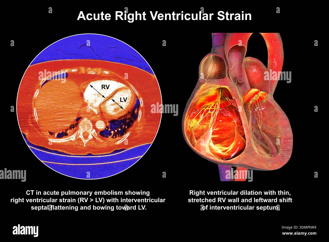 Illustration of right ventricular dilation showing a CT scan (left) and ...