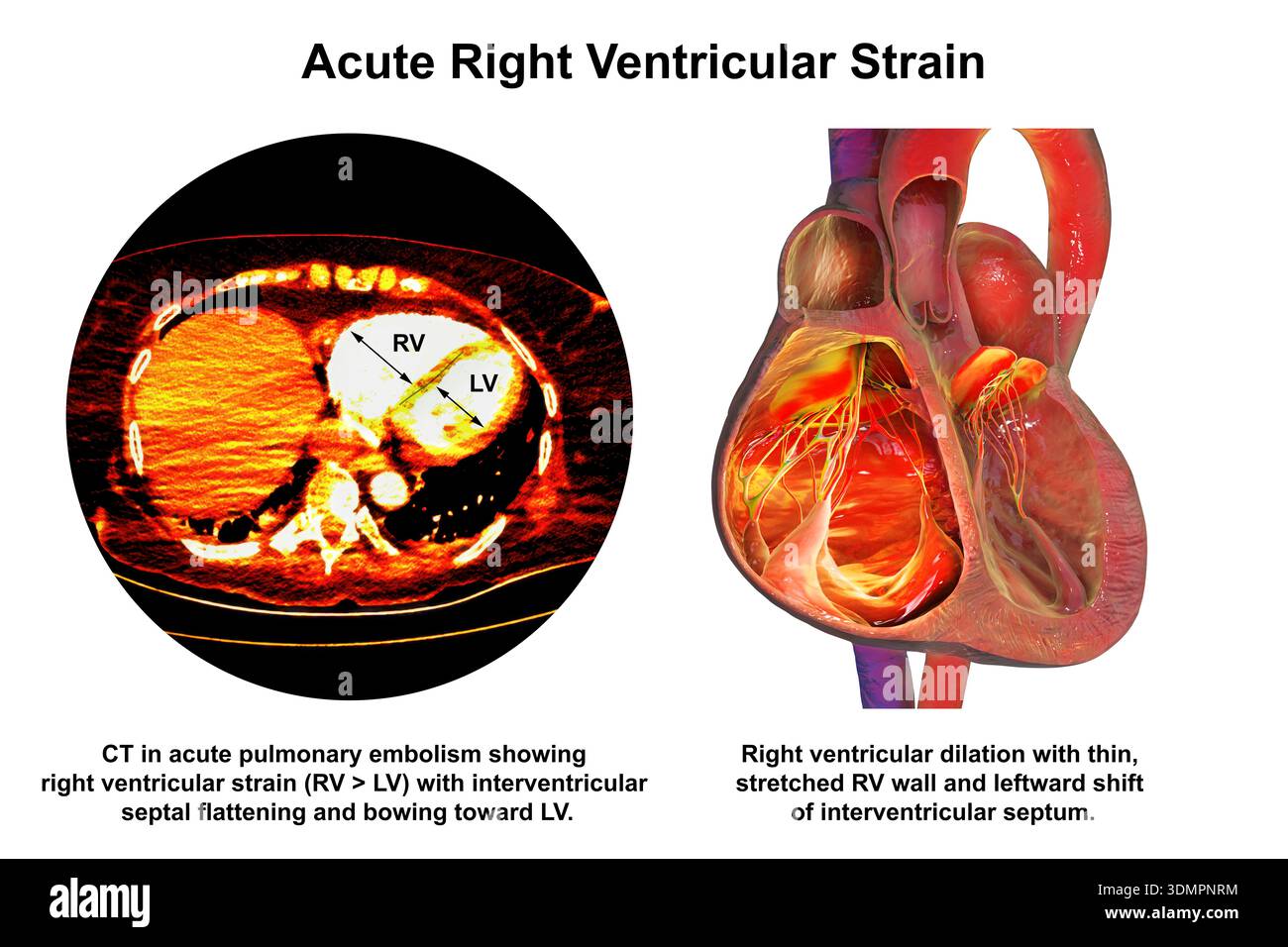 Illustration of right ventricular dilation showing a CT scan (left) and ...